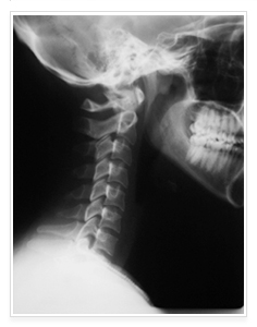 Cervical Spine Sprain/Strain – Dr. Russell D. Caram Chiropractic Physician